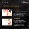갑상선암 수술 후 재발암 원인 미세잔존암 네이버 블로그