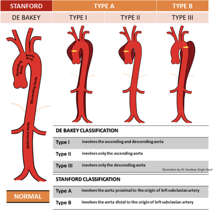 Aortic Dissection, 대동맥 박리 : 네이버 블로그