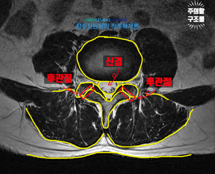 BESS (biportal endoscopic spine surgery), 수술 준비물, 수술과정 : 네이버 블로그