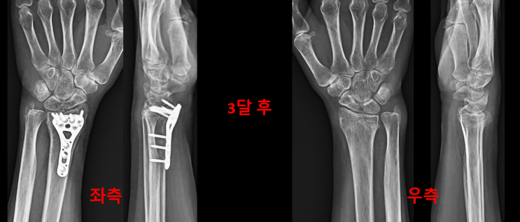 동시에 발생한 양측 손목 골절 Both Distal Radius Fracture에서 비수술 And 수술치료로 각각 치료하였던