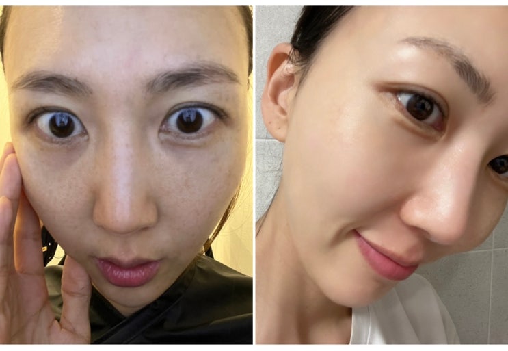 잠실 피부과 토닝 셀 테라피 3회 후기 오타모반 기미 잡티제거 Feat피코제네시스연어주사 네이버 블로그