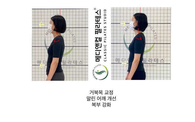 사상필라테스메디앤컬필라테스 개인레슨 허리 통증 거북목 척추 측만 비포에프터 재활필라테스 네이버 블로그