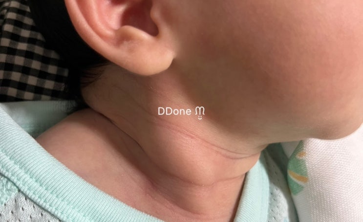 신생아 아기 사경치료👶🏻서울아산병원 미사탑재활의학과 재활치료 신생아 사경증상 네이버 블로그