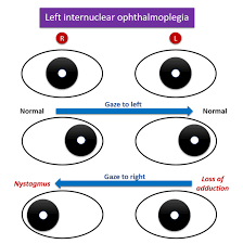핵간안근마비(Internuclear ophthalmoplegia, INO) : 네이버 블로그