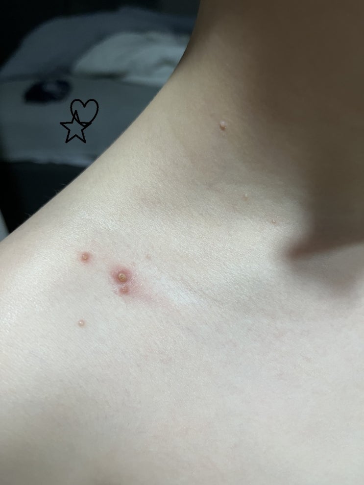 합정 편평사마귀 레이저 제거 후기 얼굴 목 상반신 제거 로션관리 1~2일차 네이버 블로그