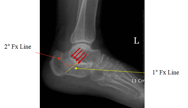 Fx-Calcaneal Fx. classification : 네이버 블로그