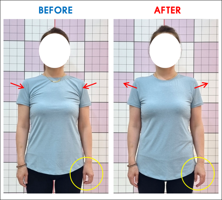 [ 송파헬리오시티 필라테스 ] 1:1 운동 후 거북목/ 굽은등 개선 및 어깨 통증 완화 Before&After : 네이버 블로그