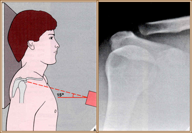 [X-ray/ shoulder/견쇄관절] Zanca view/ Shoulder AP stress view : 네이버 블로그