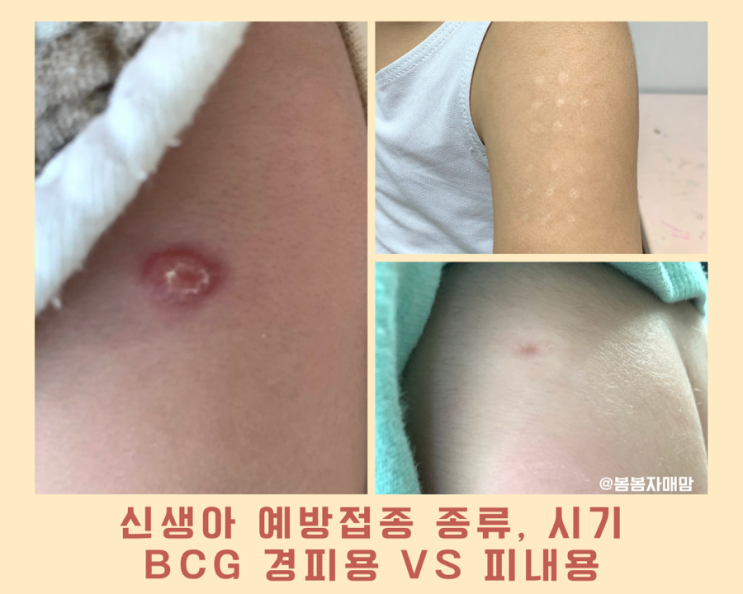 신생아 예방접종 시기 종류 Bcg 경피용 피내용 고름 흉터 B형간염 예방접종 네이버 블로그