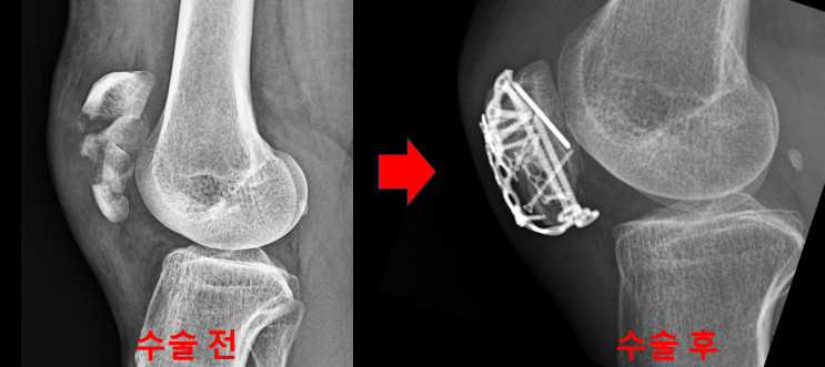 6조각이 되어버린 슬개골 골절 Comminuted Patella Fracture 수술 전 계획이 좋은 결과를 만듭니다 Ft