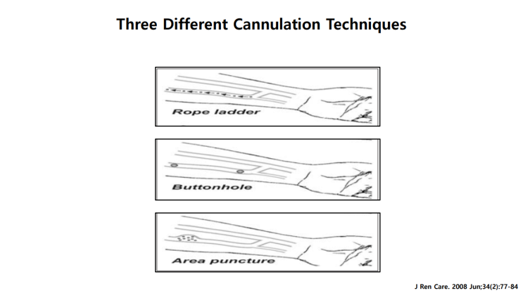 Ultrasound-Guided Cannulation : 네이버 블로그