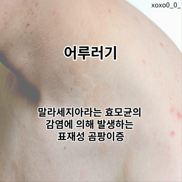 어루러기 원인 증상 치료 연고 전염 네이버 블로그