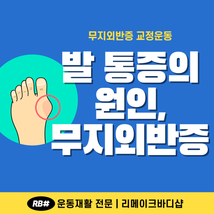 서울대입구ptㅣ5가지 방법으로 무지외반증 교정 운동 한방에 정리 네이버 블로그
