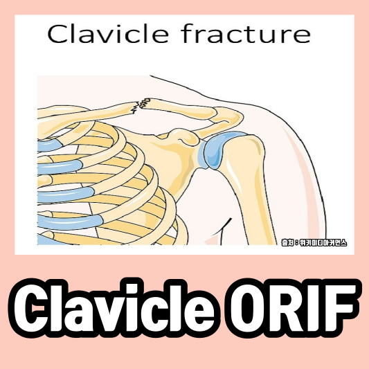 ORIF Clavicle shaft Fx 쇄골몸통 골절 수술 준비 및 과정 : 네이버 블로그