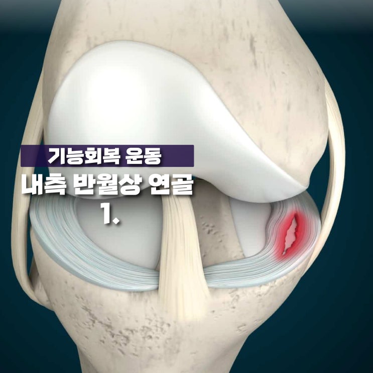 풍무동pt풍무동헬스장 마핏 내측 반월상 연골 손상 후 기능 회복운동 Part 1 네이버 블로그