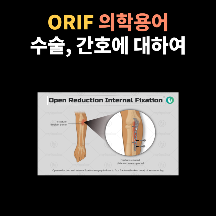 의학용어 ORIF 수술과 간호에 대해서 알아봐요~ : 네이버 블로그