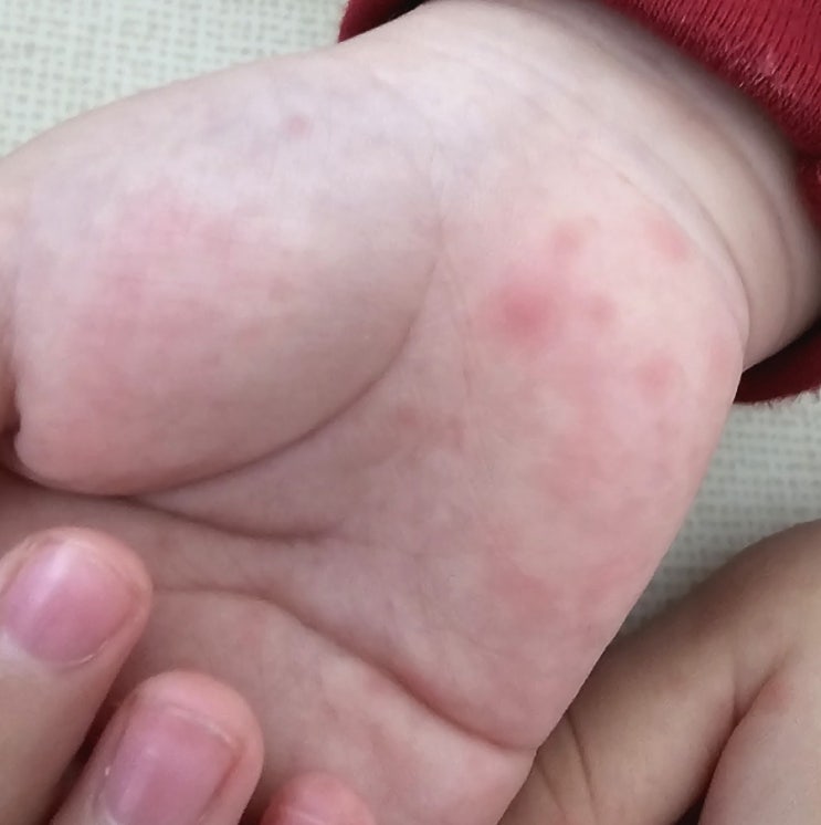 수족구 재감염 20개월 아기 수족구 수족구 증상 수족구 진행 중 네이버 블로그