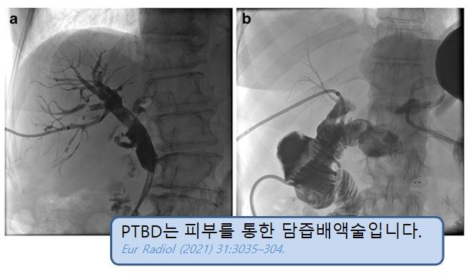 담도암의 담즙배액술(PTBD, ENBD)에 대해 알아봐요 : 네이버 블로그