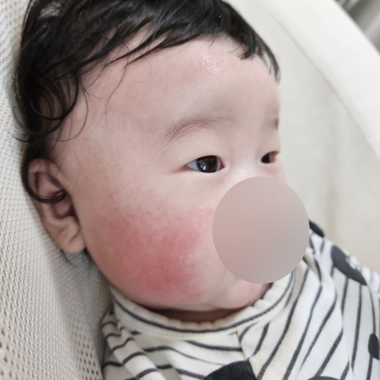 아기 접촉성 피부염 얼굴 발진 기저귀 발진 및 아기 리도맥스 유시락스 처방 후기 1탄 네이버 블로그