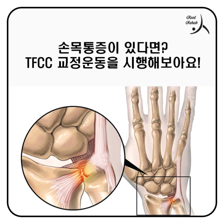 손목이 아프다면? TFCC 교정운동 시행해보자! : 네이버 블로그