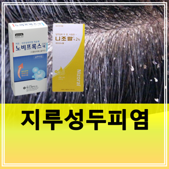 지루성두피염 원인 비듬 치료 니조랄 샴푸 노비프록스 가격 네이버 블로그