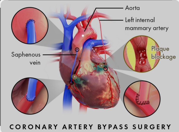 CABG 수술 후 인공심박동기 setting 공부하기 : 네이버 블로그