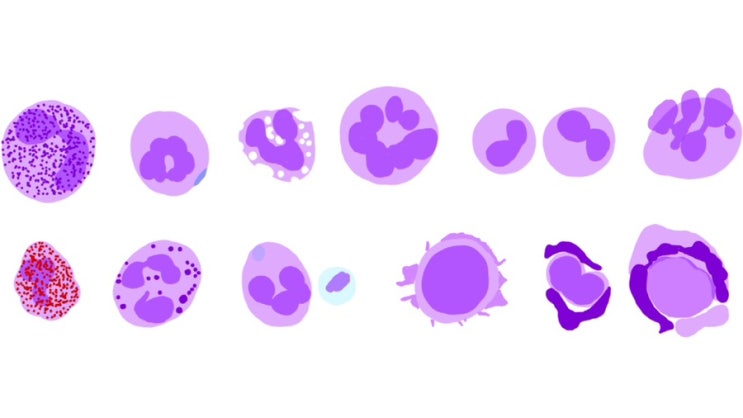 임상혈액학 백혈구 이상 형태 : 네이버 블로그