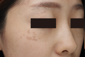 기미 오타모반 ABNOM 레이저 치료 효과 부작용 연구 : 네이버 블로그