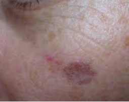 여전히 가끔 보이는 LPLK : 네이버 블로그