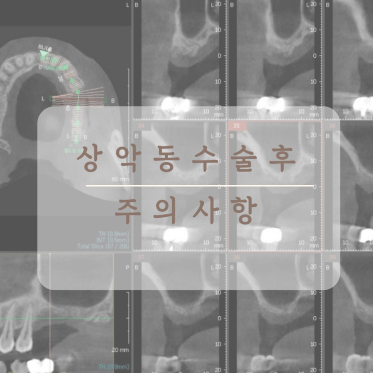 상악동 수술상악동 뼈이식술 상악동 거상술 후 주의사항 알려드려요 네이버 블로그