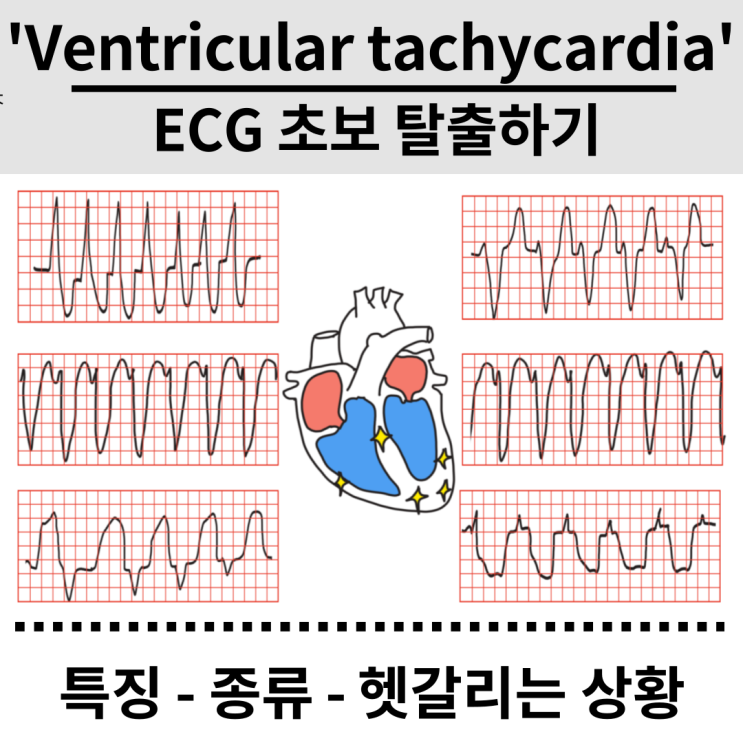 ECG 초보 탈출하기 : Ventricular tachycardia(심실빈맥, V-tach) : 네이버 블로그