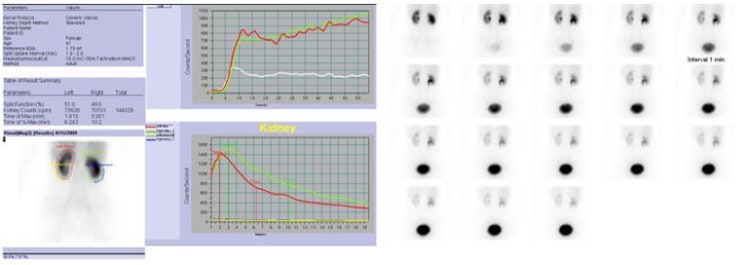 비뇨의학과 핵의학검사(MAG-3, DTPA, DMSA) : 네이버 블로그