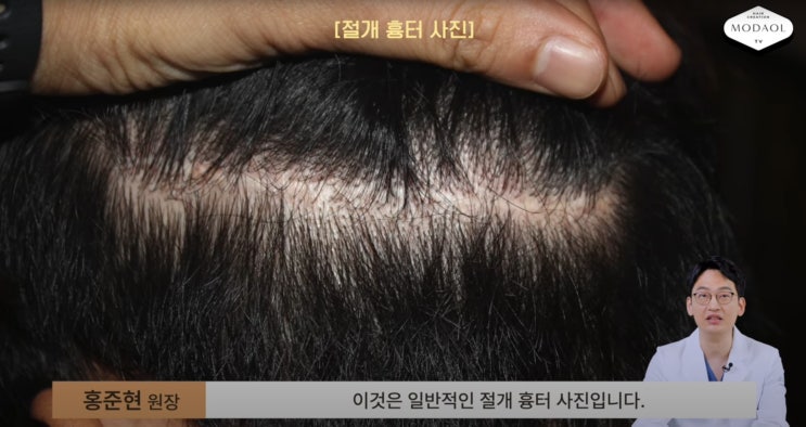 절개, 비절개 모발이식 흉터 비교 : 네이버 블로그
