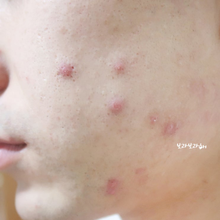 화농성 여드름 연고 부작용 없는 관리법 有 네이버 블로그