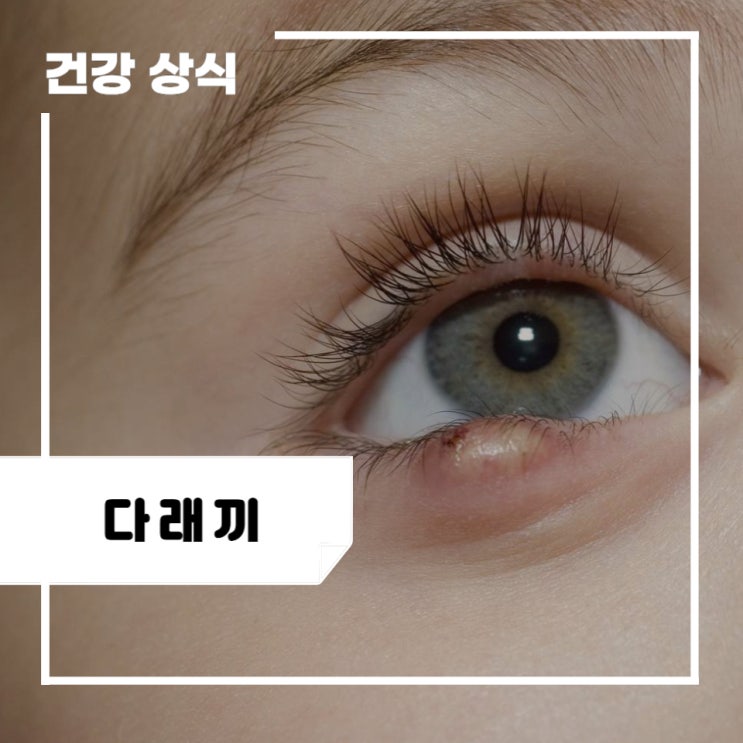 눈 다래끼 나는 이유와 원인 초기 증상 치료 약물 전염 겉 속 콩 다래끼 네이버 블로그