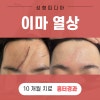 이마열상 이마 열상 봉합 후 10개월 레이저 치료 경과 Feat 흉터개선 흉터성형 성형외과 전문의 네이버 블로그