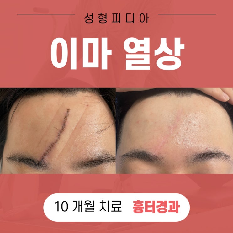 이마열상 이마 열상 봉합 후 10개월 레이저 치료 경과 Feat 흉터개선 흉터성형 성형외과 전문의 네이버 블로그