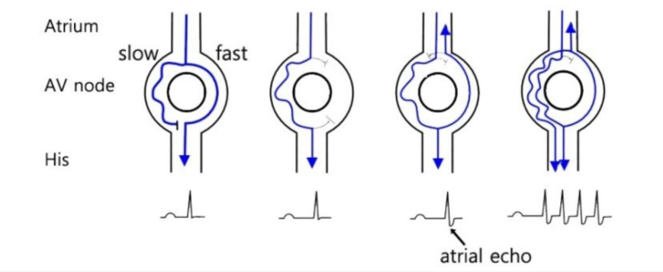 AIVR, AVNRT, AVRT : 네이버 블로그