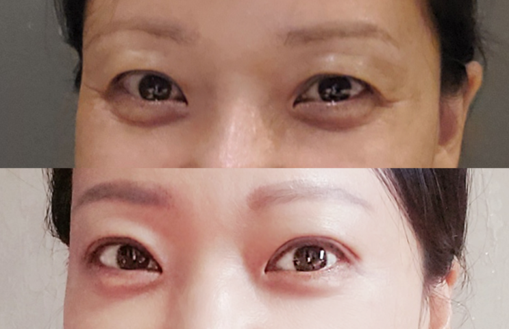 처진눈꺼풀고민 리아이성형외과에서 상안검수술과 눈위지방제거수술 받은지 한달차 후기 눈처짐수술비용상안검수술가격 공유