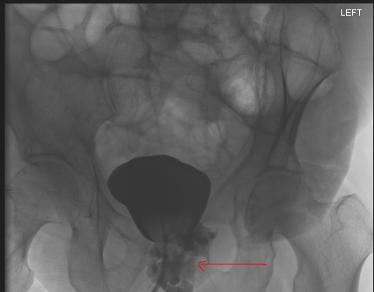 전립선 암 수술 후 검사: Cystography : 네이버 블로그