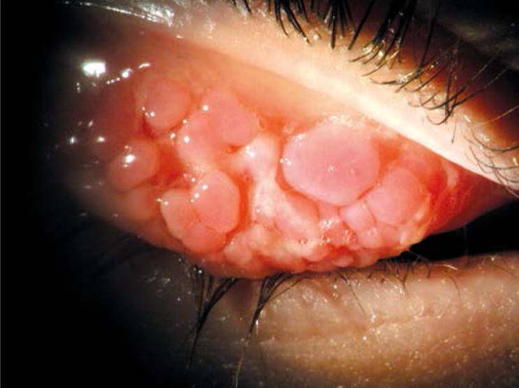 알레르기 결막염(Allergic conjunctivitis) ④ - 거대유두결막염(Giant papillary conjunctivitis, GPC) : 네이버 블로그