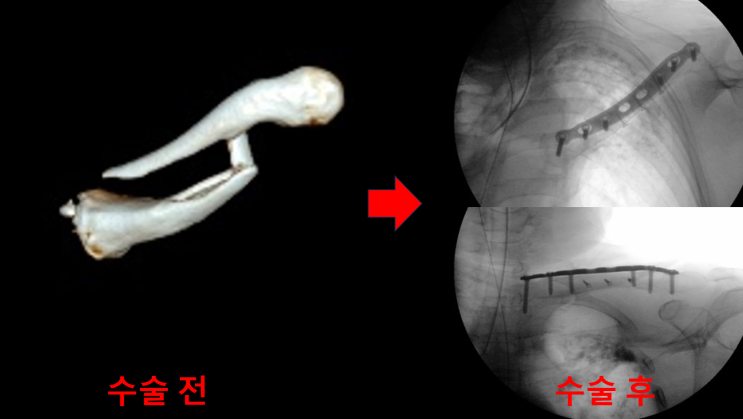 오토바이 사고 후 발생한 쇄골 간부 골절 Clavicle Shaft Fracture 수술적 치료 후 일상 회복은 얼마나