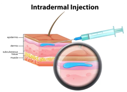 피내주사(Intradermal injection, ID) 목적과 시행방법 / 핵심 간호 술기 순서와 간호기록 : 네이버 블로그