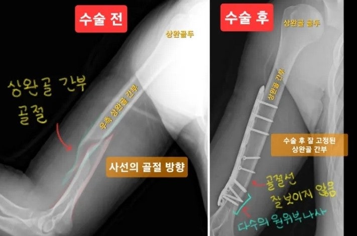 상완골 골절 후 발생한 마비는 언제 돌아올까요 팔씨름 후 생긴 상완골 골절 및 동반된 마비에 대한 치료 Humerus