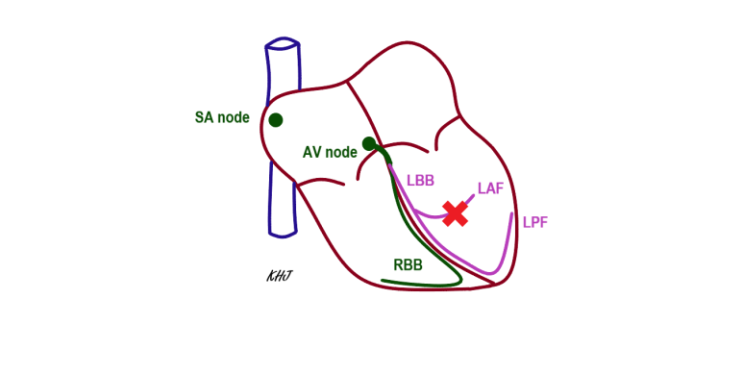 LAFB / LPFB ECG : 네이버 블로그