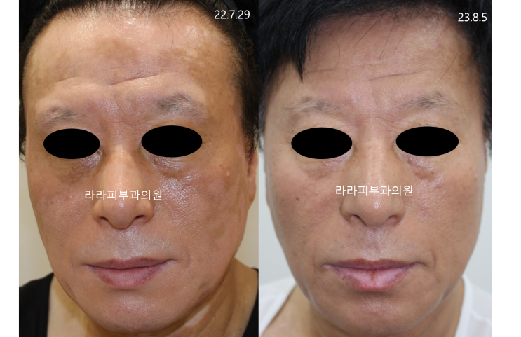 부산 해운대 센텀 백반증 건선 엑시머레이저치료 및 백반증 피부이식sst 효과 좋은 라라피부과의원 네이버 블로그