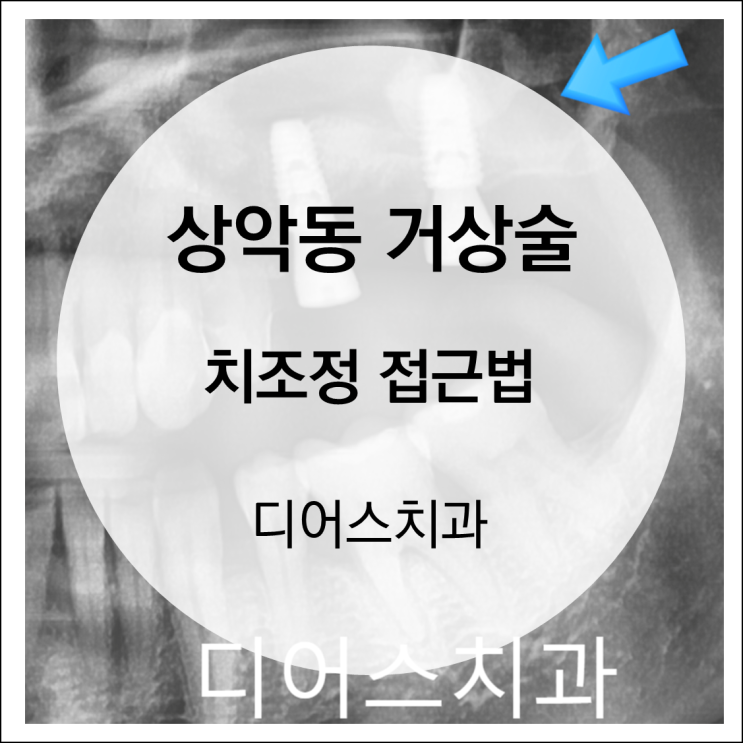 상악동 거상술의 종류 치조정 접근법 치료기간 명일동 암사동 천호동 임플란트 치과 네이버 블로그