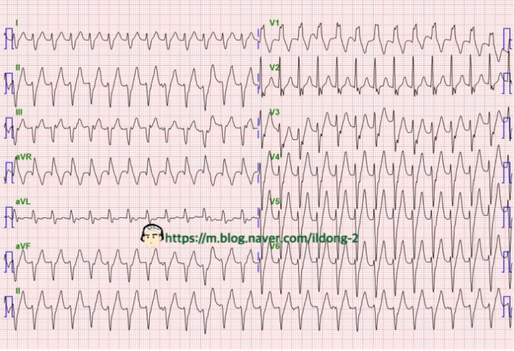 베라파밀에 반응하는 부정맥 fascicular VT (섬유속 심실빈맥) : 네이버 블로그