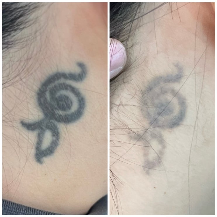 타투제거 문신제거 효과 후기 (1년째) : 네이버 블로그