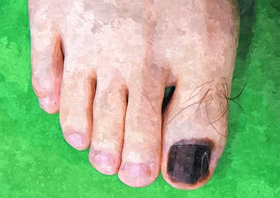 발톱 흑색종에 대한 이해 원인, 증상 및 ㅊl료 : 네이버 블로그